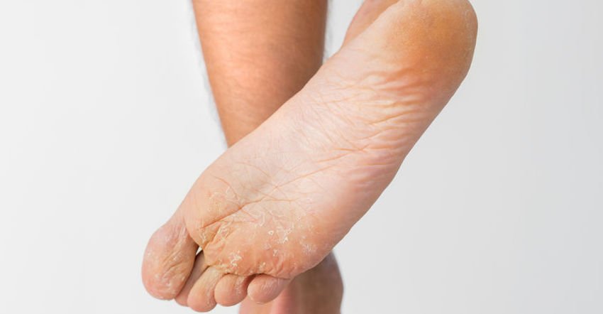 Hyperhidrosis of the Feet Is Caused by Overactive Sweat Glands