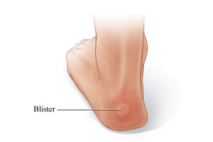 Blister Treatment in Novi, Southfield, Howell, Livonia