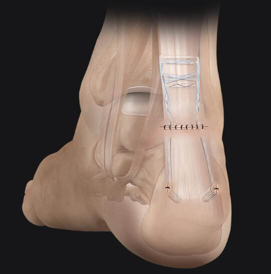Achilles Tendon Repair in Novi, Southfield, Howell, Livonia