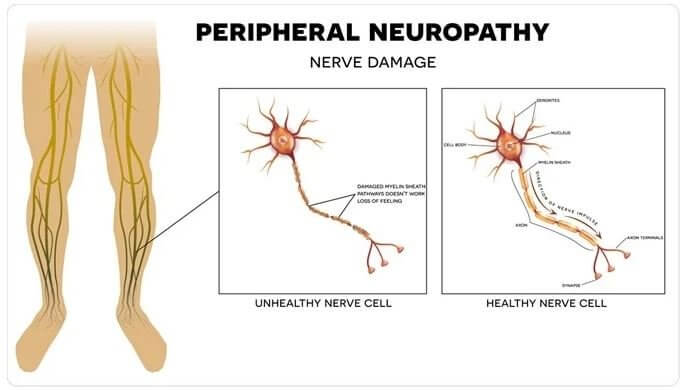 Peripheral Neuropathy Treatment in Novi, Southfield, Howell, Livonia